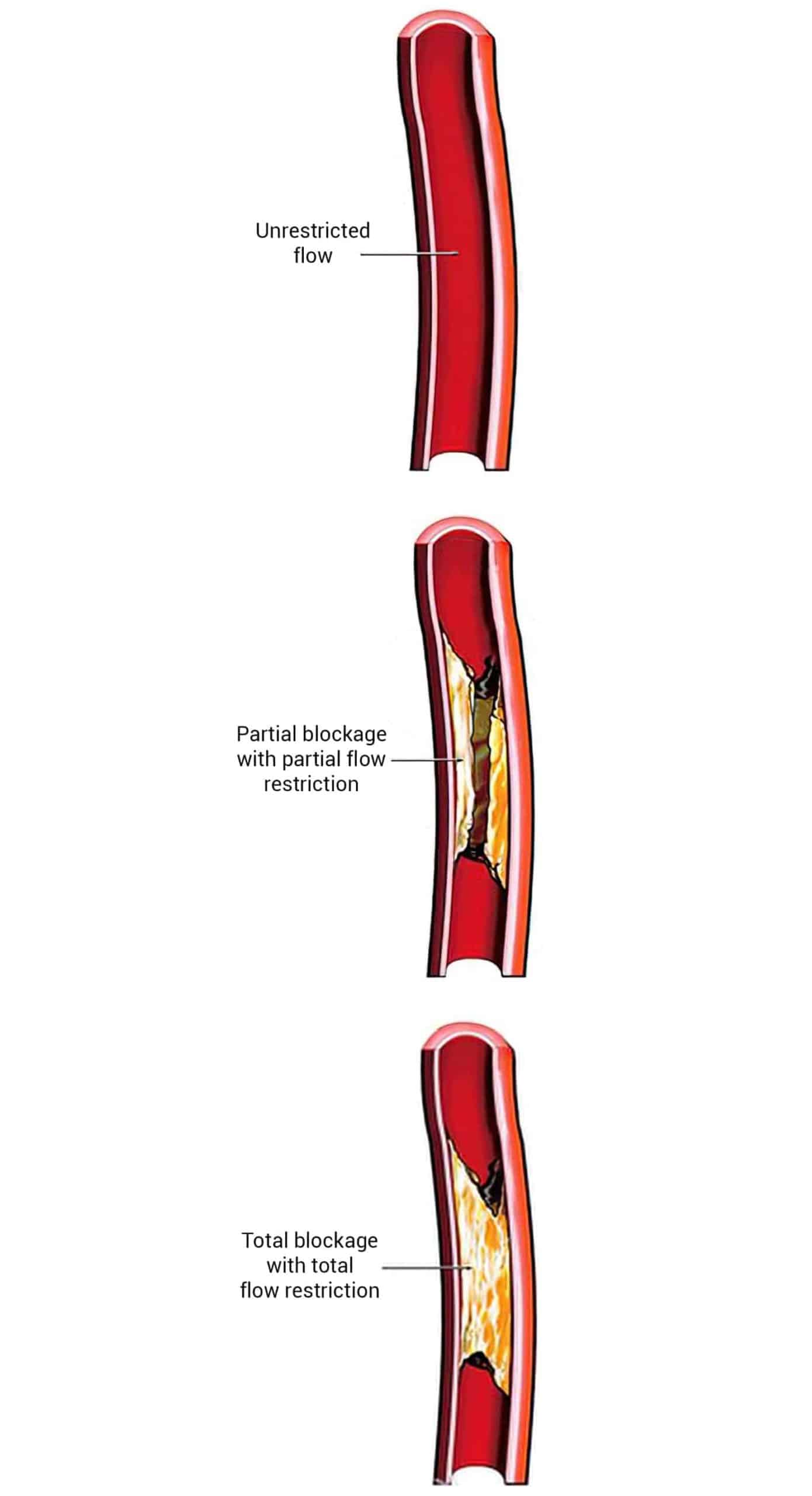 What is Heart Blockage/Blocked Arteries?