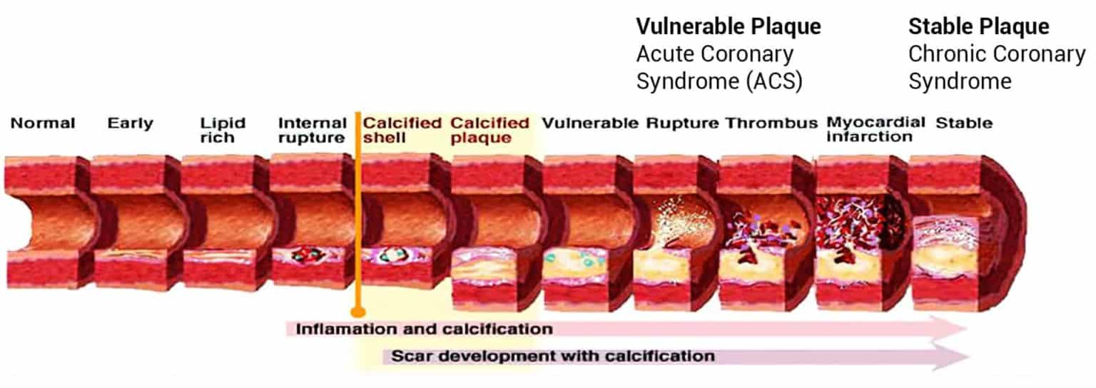 What is Heart Blockage/Blocked Arteries?